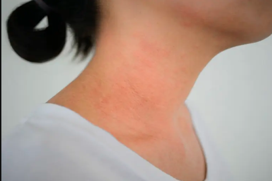 Što je atopijski dermatitis? - Virtualna ordinacija